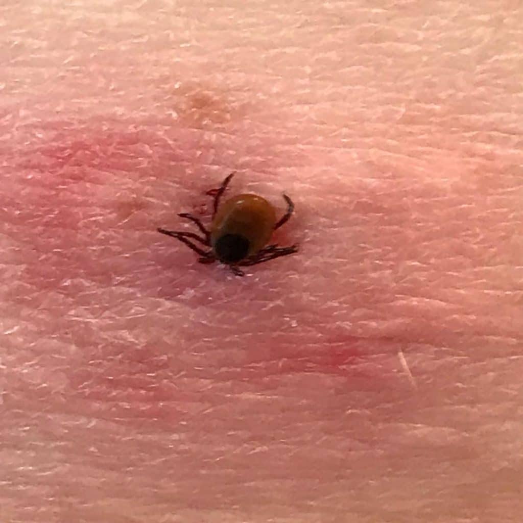 Tick on skin Pest Hacks